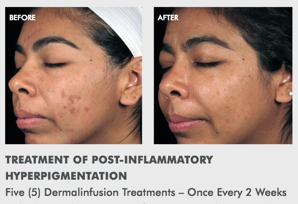 DermalInfusion Skin Resurfacing CT | Jennifer Pennoyer, MD