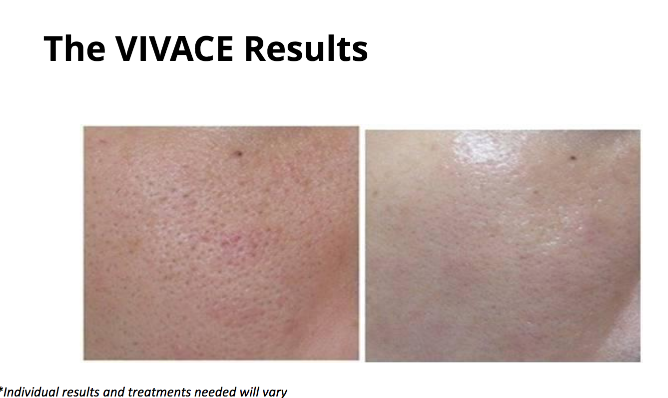 Vivace Microneedling Hartford County | Jennifer Pennoyer, MD